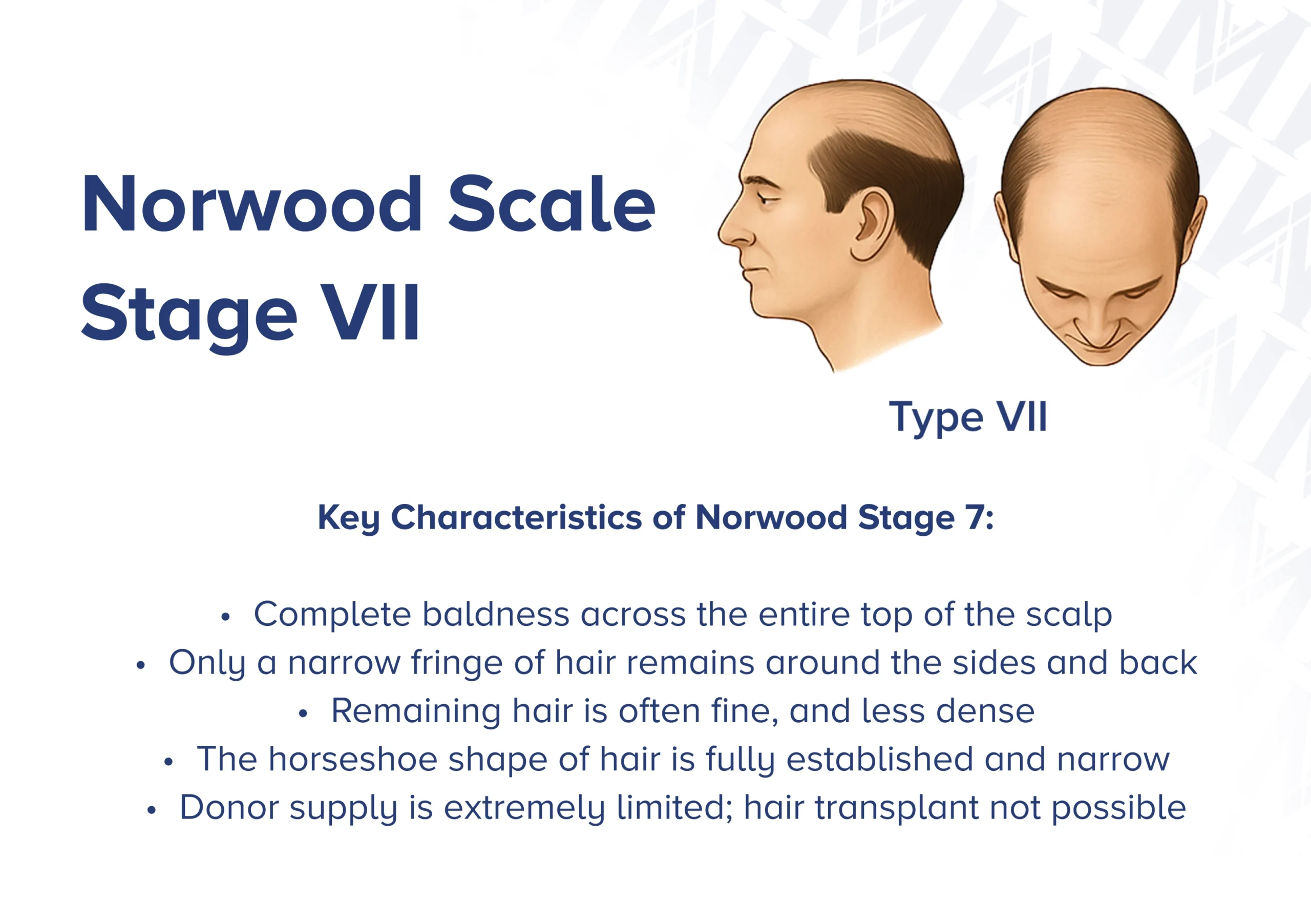 Escala de Norwood: Etapas de la Pérdida de Cabello y Tratamientos ...