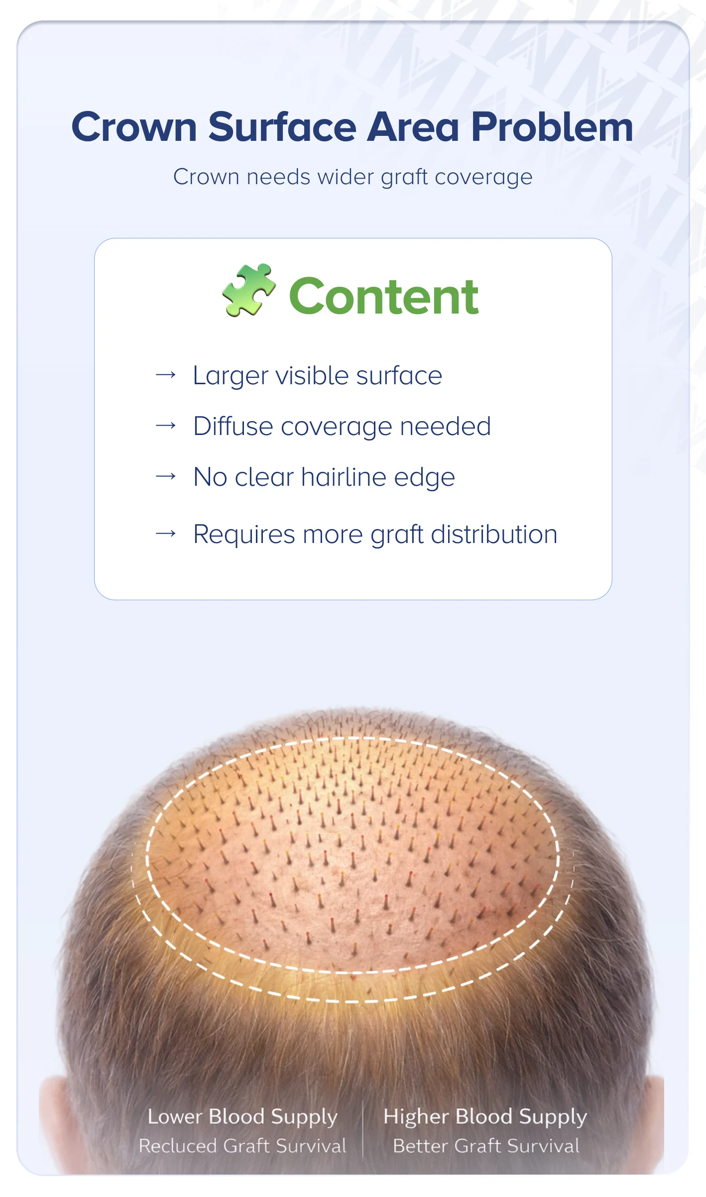 Hair Transplant Crown & Vertex: Challenges, Grafts Needed, and ...